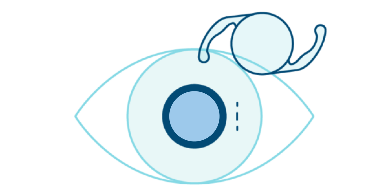 Vision Correction Procedures