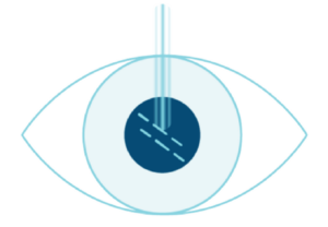 ClearSight LASIK and Lens - Oklahoma City, OK and Plano, TX Vision ...