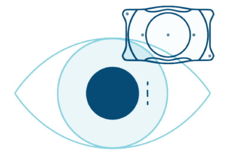 ClearSight LASIK and Lens - Oklahoma City, OK and Plano, TX Vision Correction